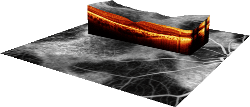 Macular Degeneration & Diabetic Retinopathy in Medford & Grants Pass ...